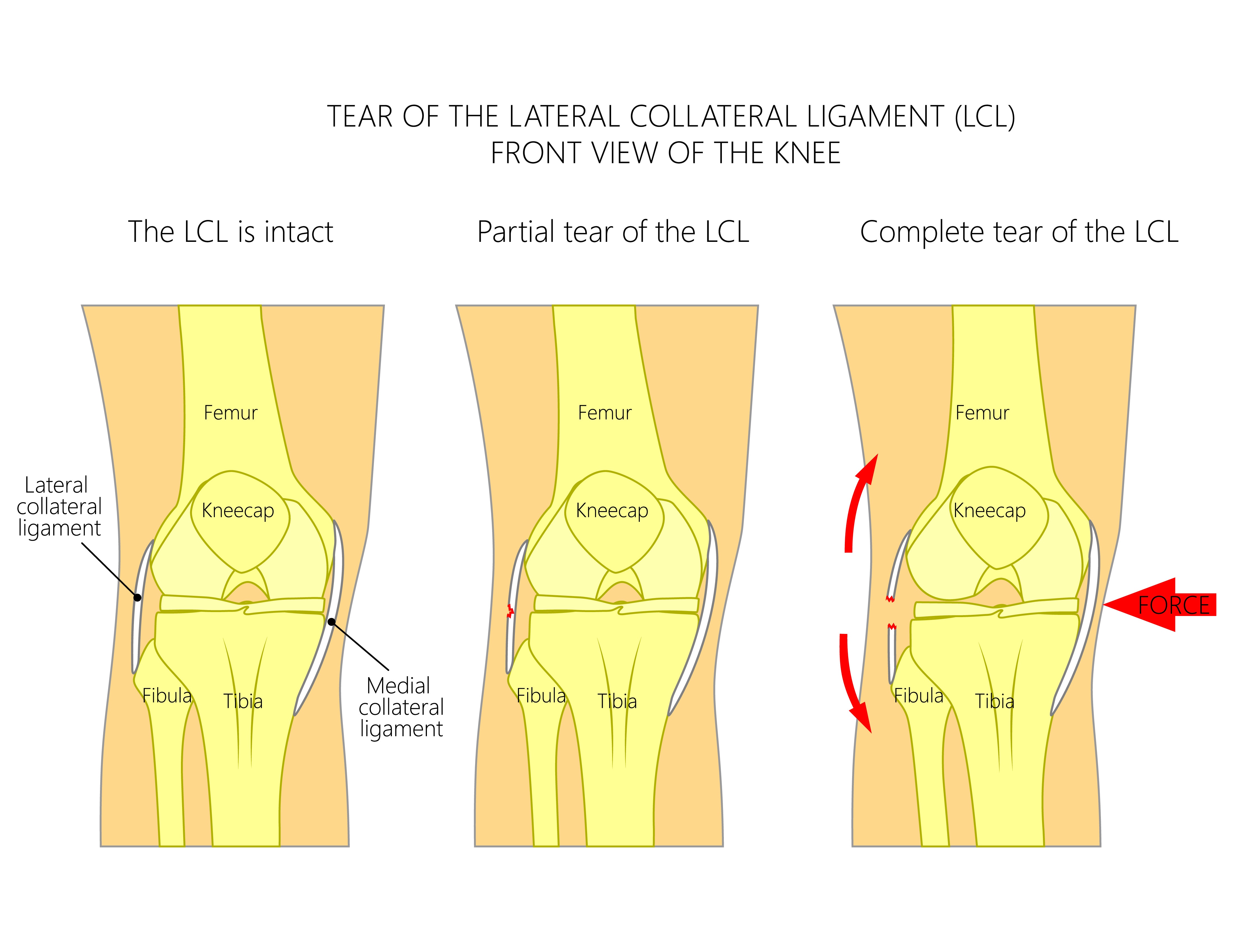 Lateral Collateral Ligament Injury Physio Treatment Toronto Simply