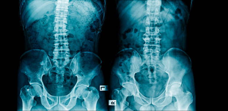 Consult Our Experts For Adult Degenerative Scoliosis | Simply Align Rehab